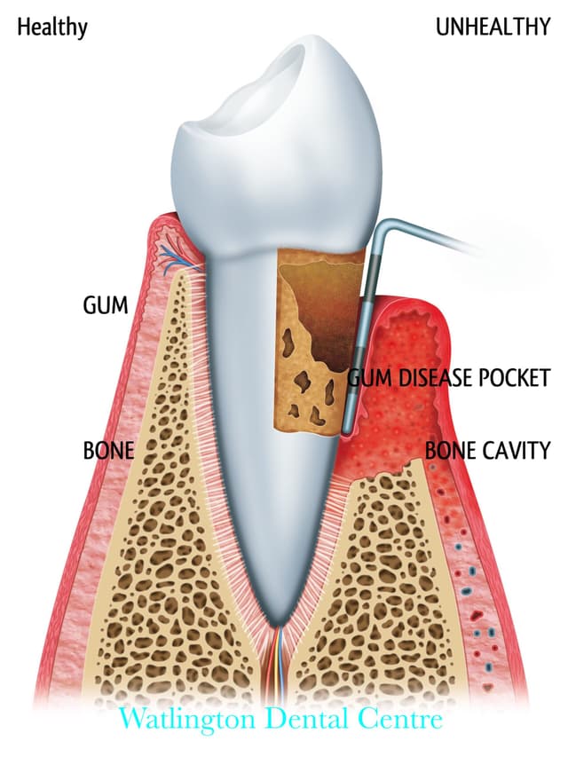 Gum Disease Treatment by Specialist Periodontist